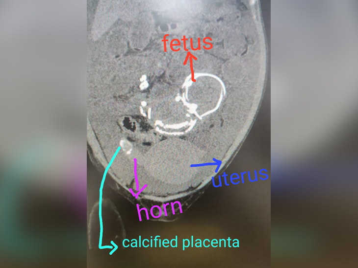 Stone Baby (Lithopedion) Found In Raipur's Jawaharlal Nehru Medical ...
