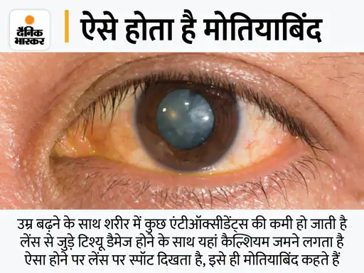 Motiyabind Heart Connection; Cataracts Eye Disorder Risk Of Death From ...