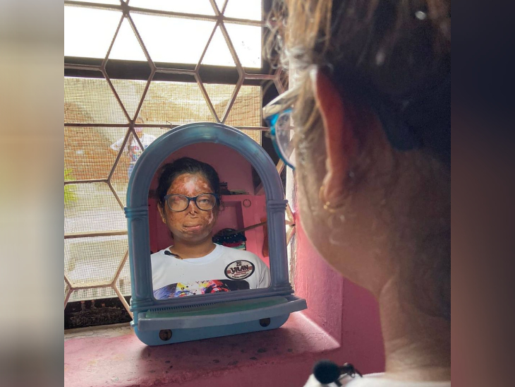 Acid Attack Survivors Anshu Rajput Story | Anshu Recalls Acid Attacks ...