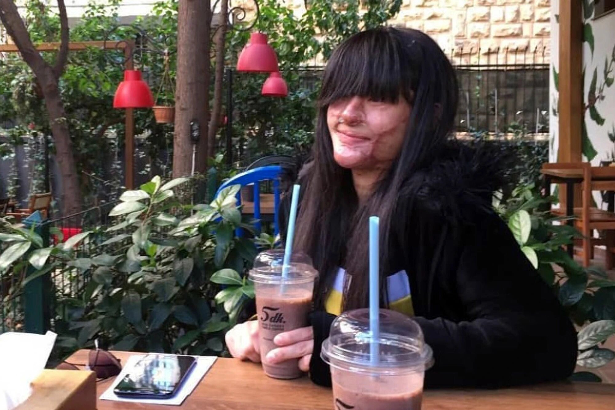 Acid Survivor Berfin Ozek marries Casim Ozan Celti in Turkey | तुर्की ...