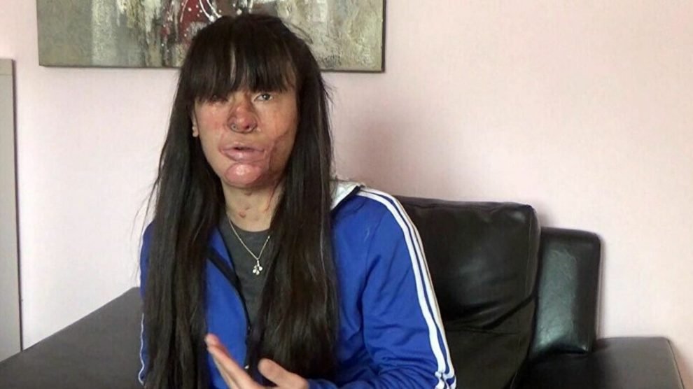 Acid Survivor Berfin Ozek marries Casim Ozan Celti in Turkey | तुर्की ...