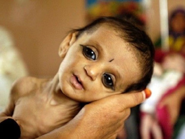 Malnutrition (Kuposhan) In Madhya Pradesh; Women And Child Development ...