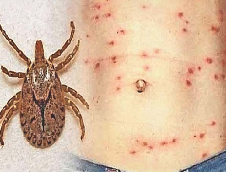 Outbreak of scrub typhus in the district, first patient found in Tili, referred to Bhopal in ...