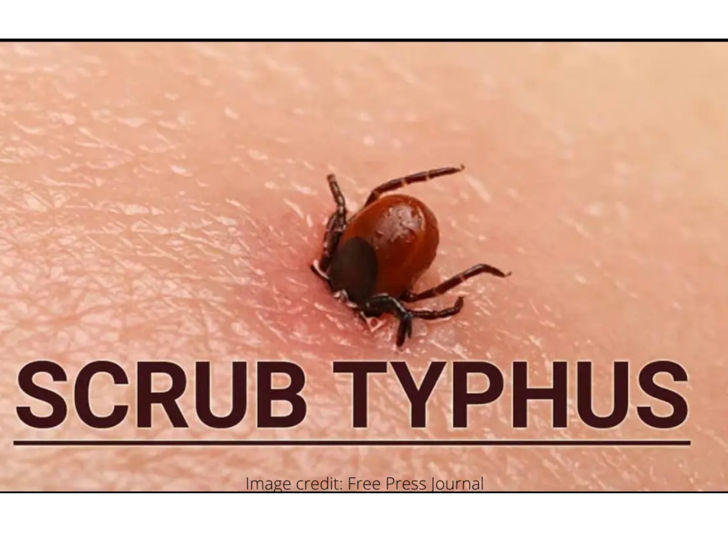 4 new patients of scrub typhus found in Satna, samples of 56 suspected patients sent for ...