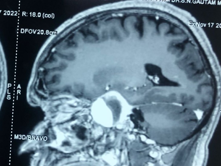 Rajasthan kota Diverter inserted in brain vein, Neuro surgery, Dr. SN ...