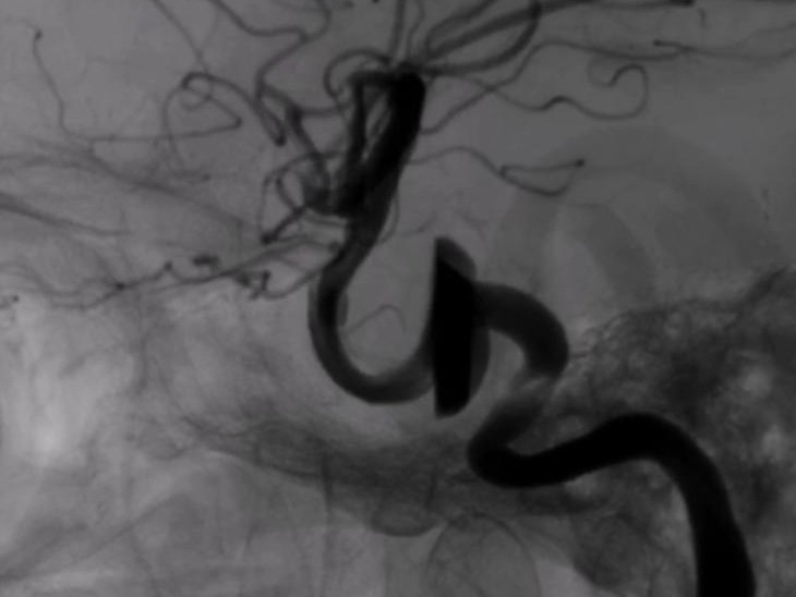 Rajasthan kota Diverter inserted in brain vein, Neuro surgery, Dr. SN ...