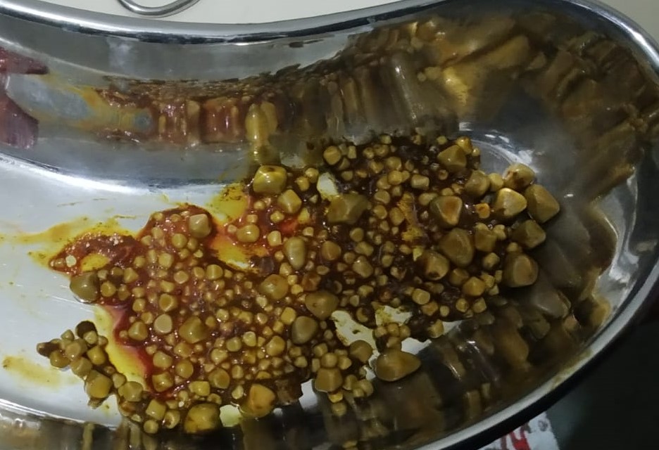Kidney Stone Surgery | MP Doctors Remove 382 Stones From Woman's ...
