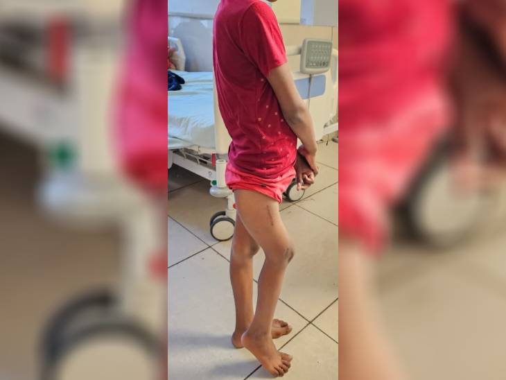 Treatment of crooked bone and short leg by Russian method 10 year old ...