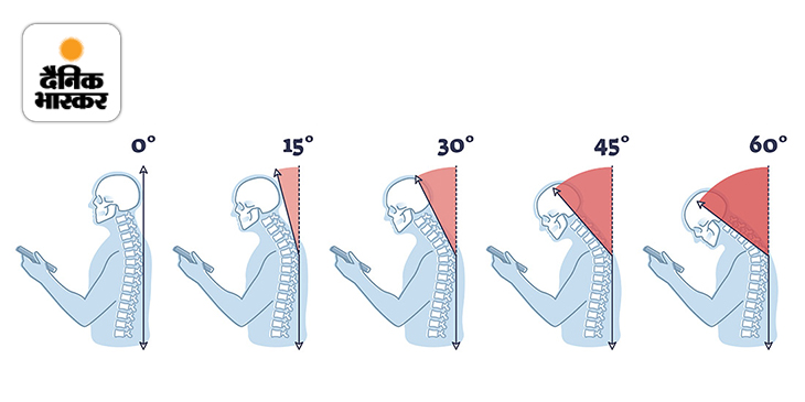 Body Posture Types Explained; How to Improve Posture For Healthy Back ...