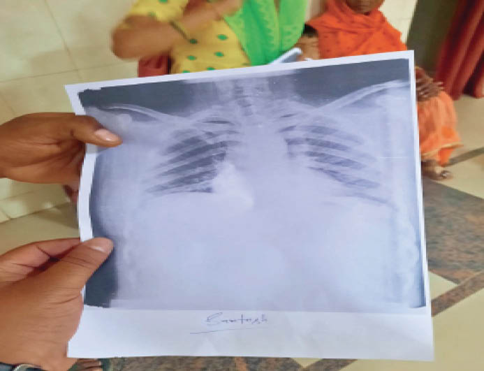 जिला अस्पताल में एक्स-रे फिल्म नहीं, मरीजों को ए-4 साइज के कागज पर दे ...