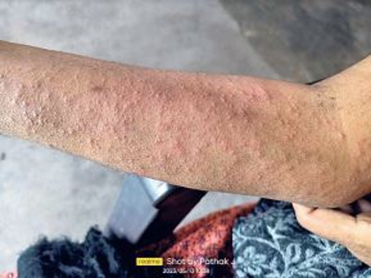The problem of skin allergy has increased, infection like smallpox is ...