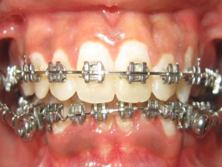 Doctors at BHU in Varanasi have invented a technique to treat crooked ...