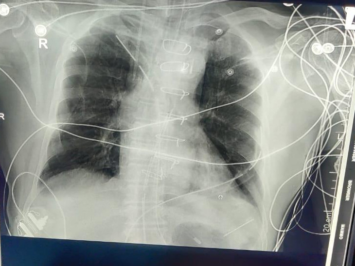 Hospital said- no facts of instrument being found in X-ray, family's ...