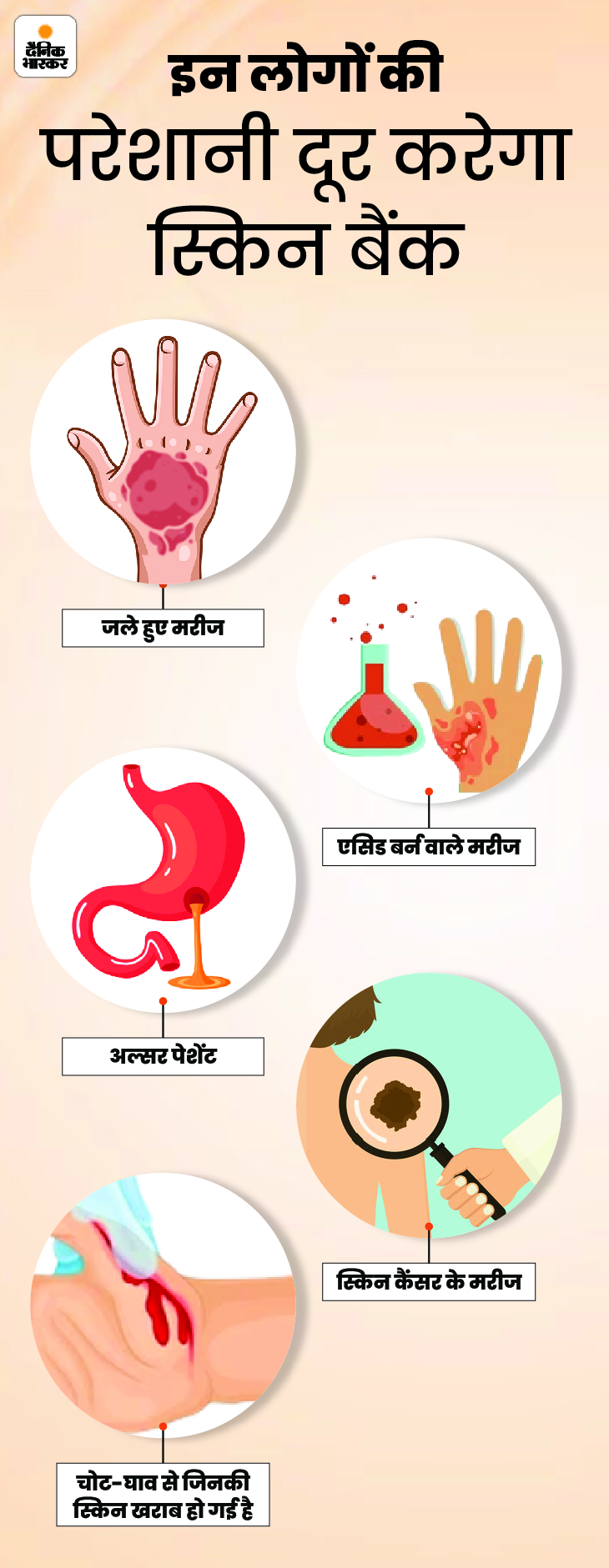 Delhi Skin Bank; Skin Donation Process Explained (How Skin Bank Work ...