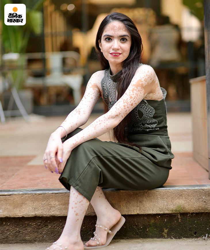 Safed Daag Victim Story | Mumbai Delhi Vitiligo Women Struggles with ...