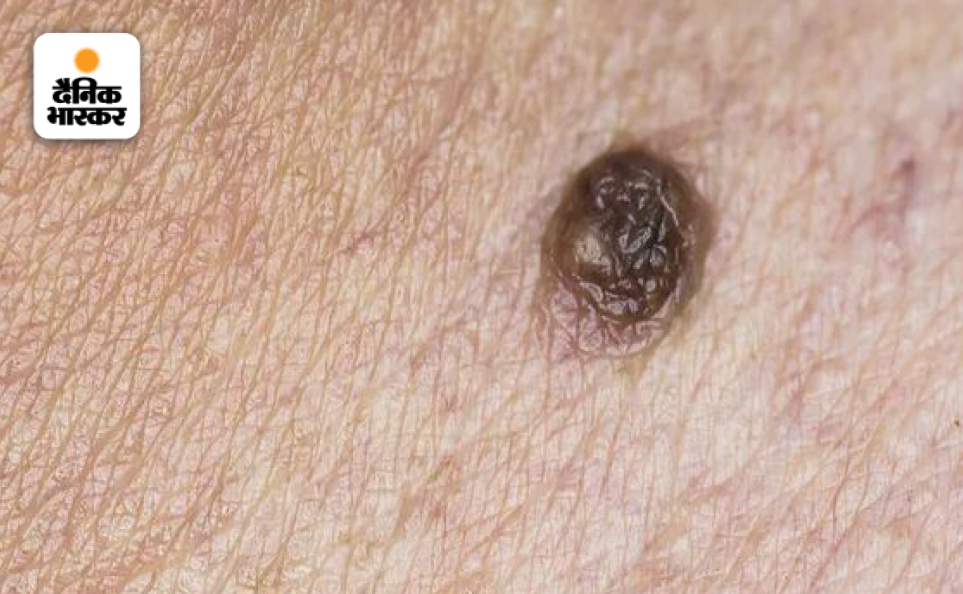 Warts caused by obesity or HPV virus