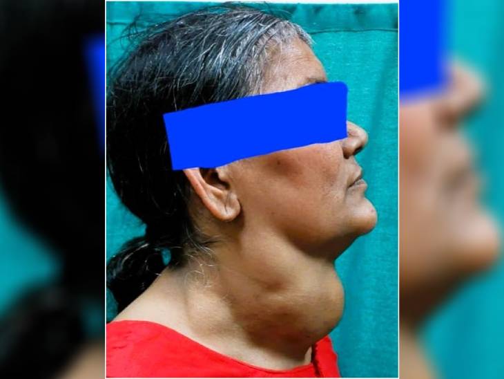 Difficult operation of goiter lump of woman in AIIMS | एम्स में महिला ...