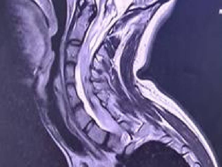 World's largest spinal tumor surgery performed in AIIMS। Additional ...