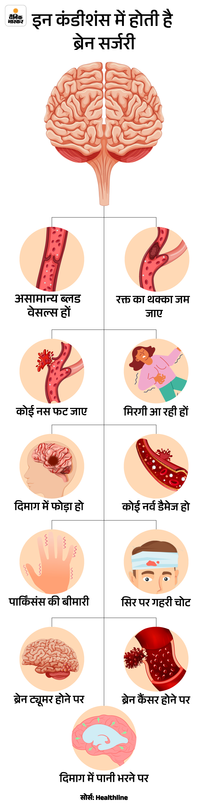 Sadhguru Brain Surgery Reason Explained | Brain Surgery Types, Risk ...