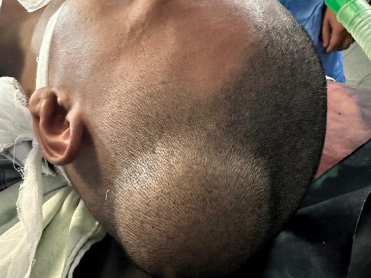 The patient's head lump was successfully operated | बोन सीमेंट से नई ...