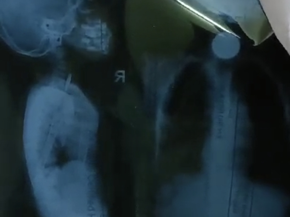A two rupee coin got stuck in the throat of an innocent child