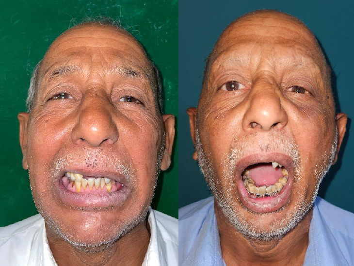 Jaipur Jaw Transplant Operation; RUHS Hospital (Dental College)