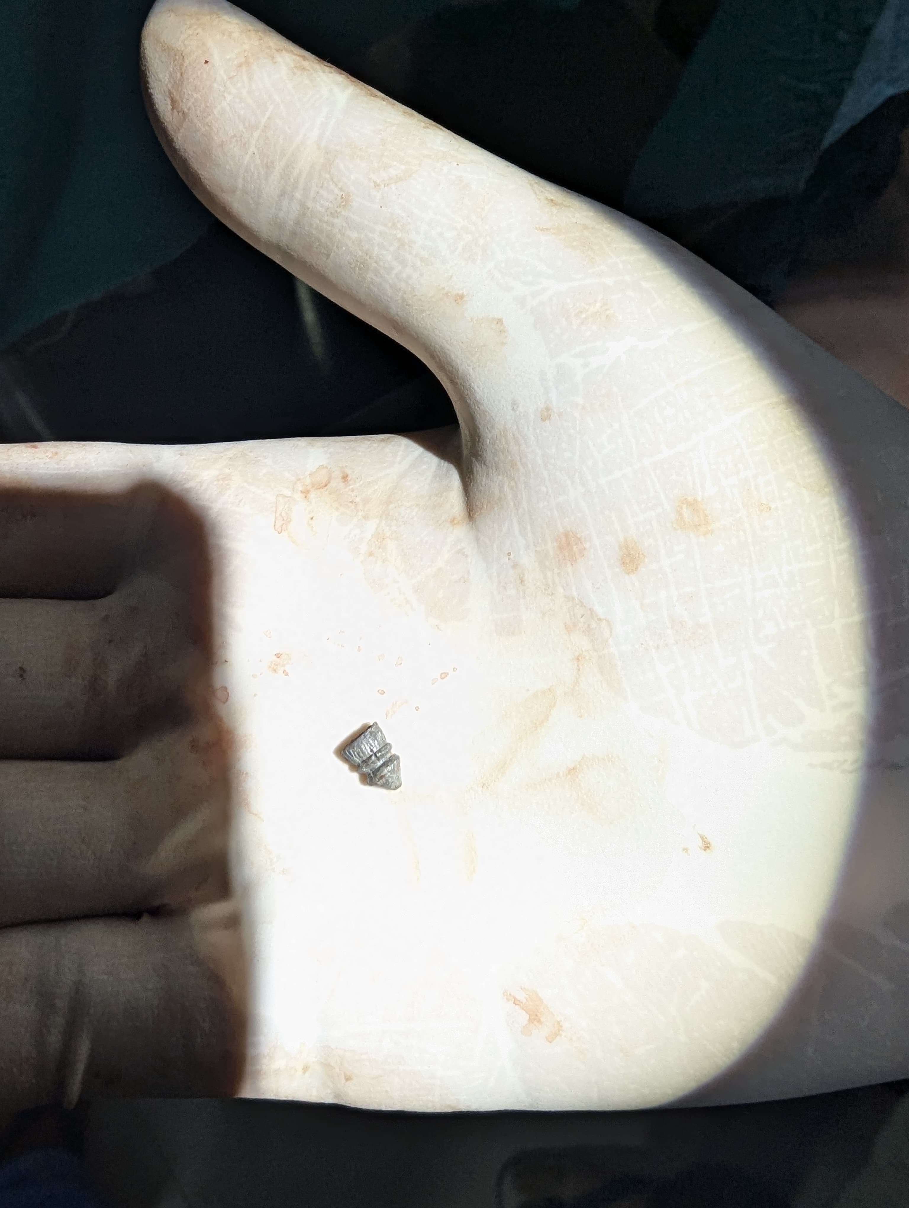 Rajasthan Ajmer Hospital Air Gun Bullets Removal Surgery | Ajmer News ...