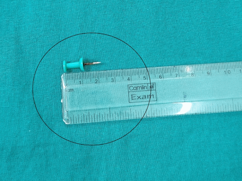 Udaipur Thumb Pin Removal Surgery | TB Hospital | सांस नली से 2.2 इंच ...