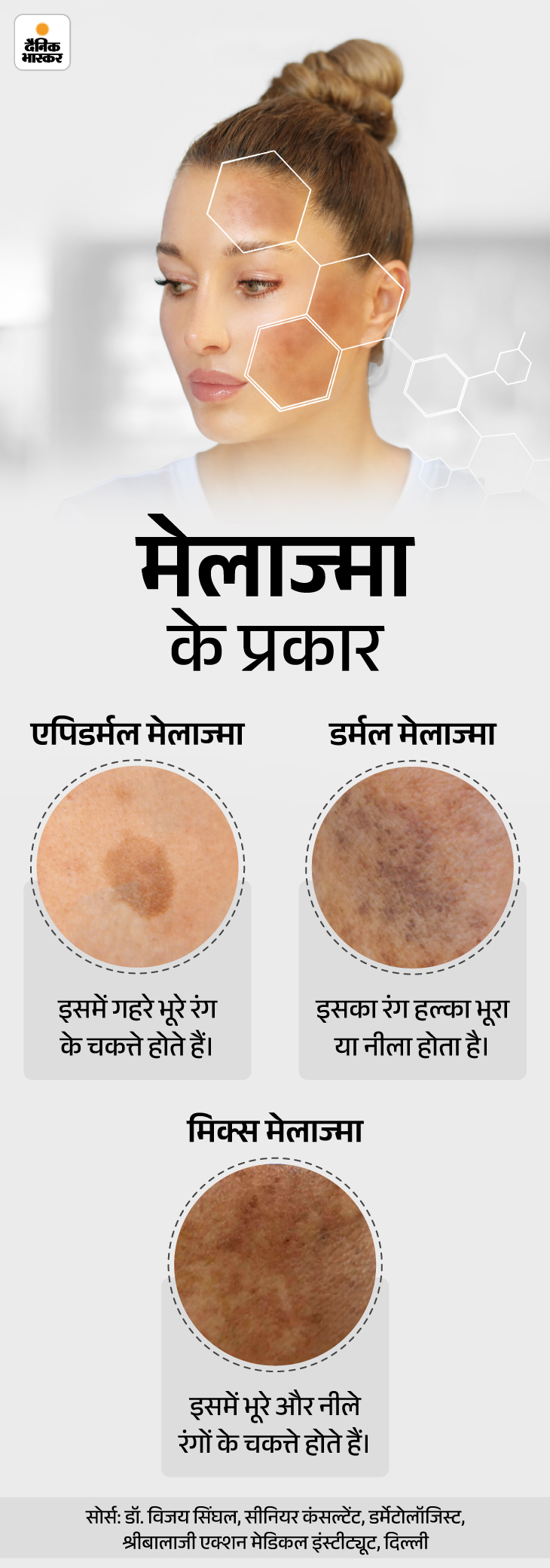 Melasma Initial Symptoms; Skin Brown Or Gray-brown Patches