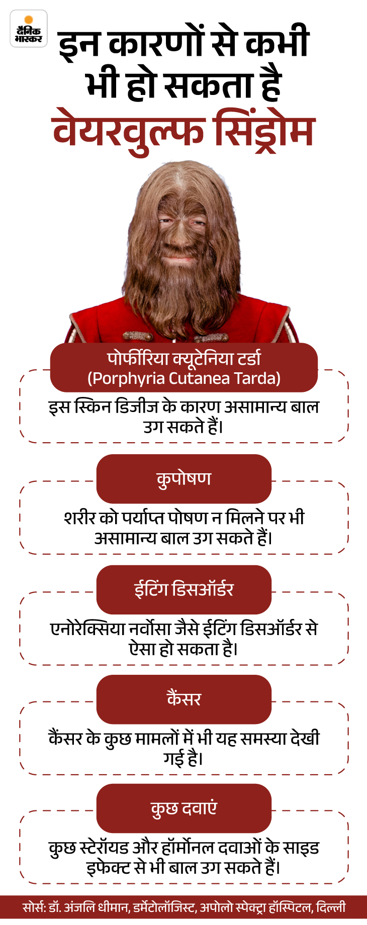 Werewolf Syndrome Symptoms; Hypertrichosis | Genetic Disorder ...