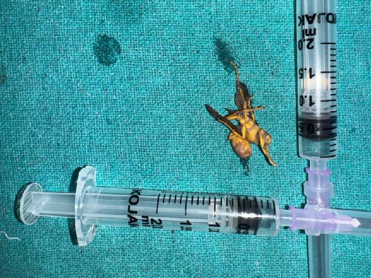 Worm stuck in 6-month-old baby's chest, blocking lungs