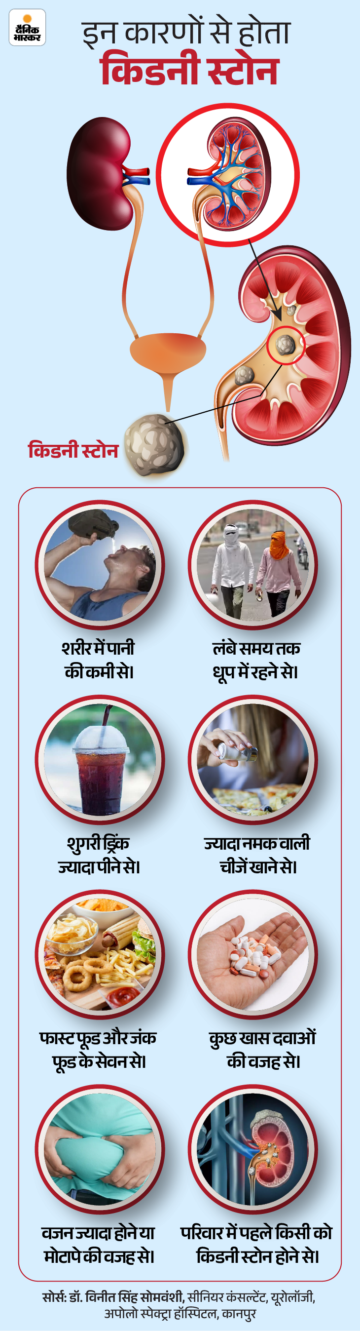 Summer Kidney Stone Problem; Signs And Symptoms Explained | किडनी स्टोन ...