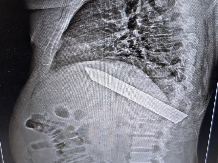 Lucknow - KGMU - Trauma Centre - The iron rod pierced the stomach and ...