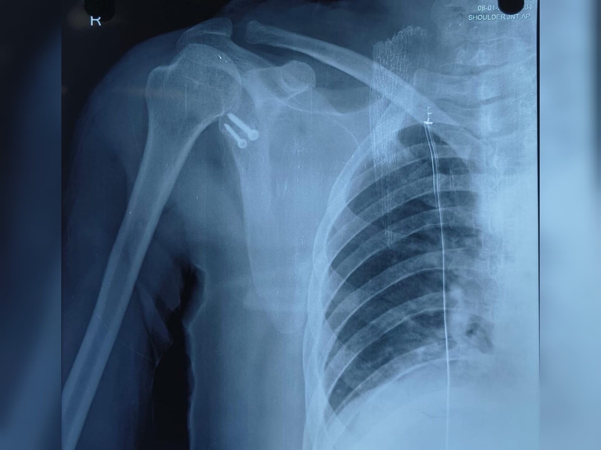 UP Medical University Successfully Treats Habitual Shoulder Dislocation ...