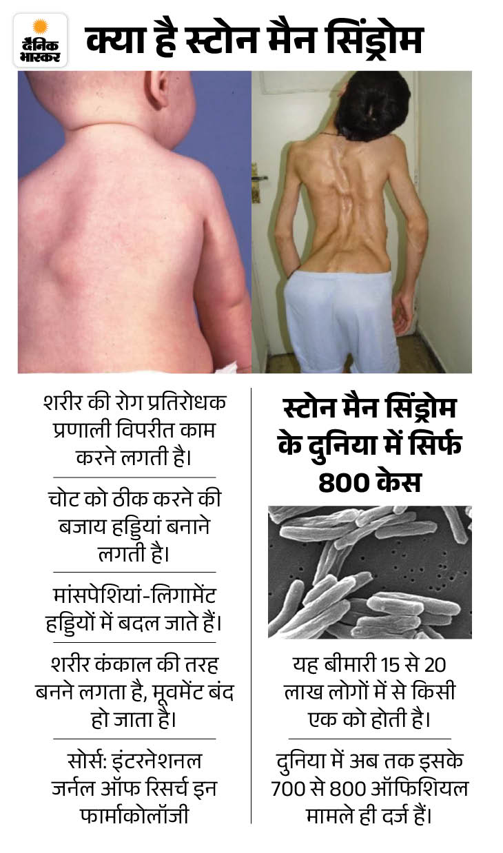 Rajasthan Stone Man Syndrome First Case | Jaisalmer Rare Disease