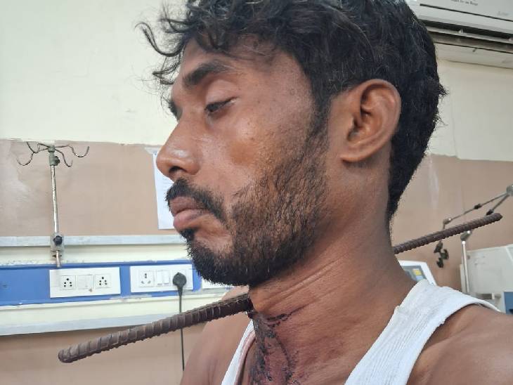 Indore Doctors Save Laborers Trachea & Esophagus After Iron Rod Injury