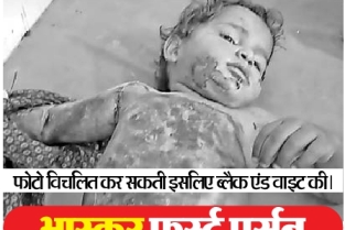 The girl was playing with matches, her frock caught fire, she suffered ...