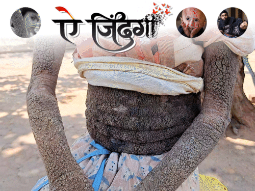 Chhattisgarh Genetic Skin Disorder Case; Tree Man Syndrome Symptoms ...