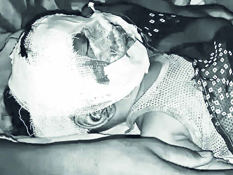 Jackal attacks 6-month-old: Lips and cheeks bitten, 20 stitches required