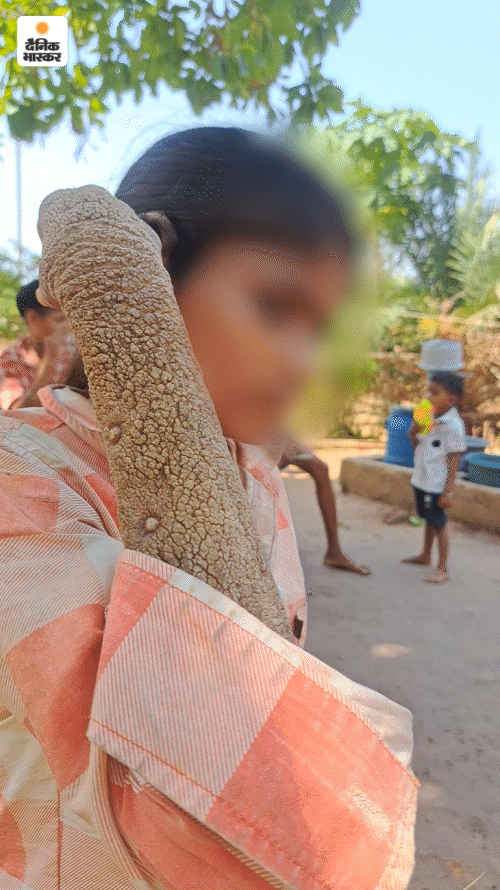 Raipur AIIMS Resumes Treatment for Rare Skin Disease; Jagishwaris Battle