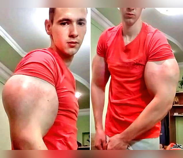 Russian Man Who Took Synthol Injection For Hulk Like Body | कित्येक ...