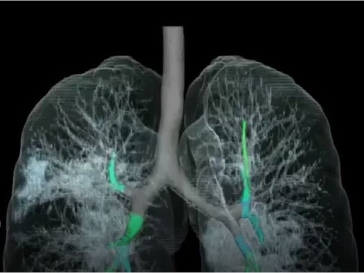 First 3D image of coronavirus infected lungs exposed, scary picture ...
