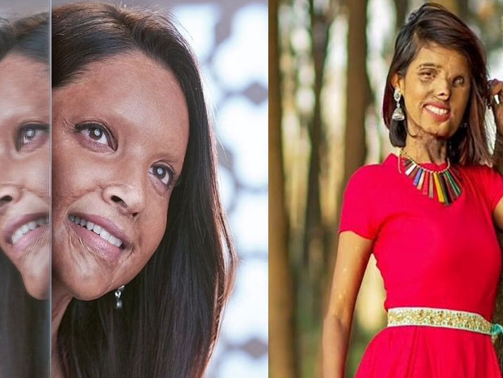Acid attack victims say, 'Our face burns, we don't lose heart, of acid ...
