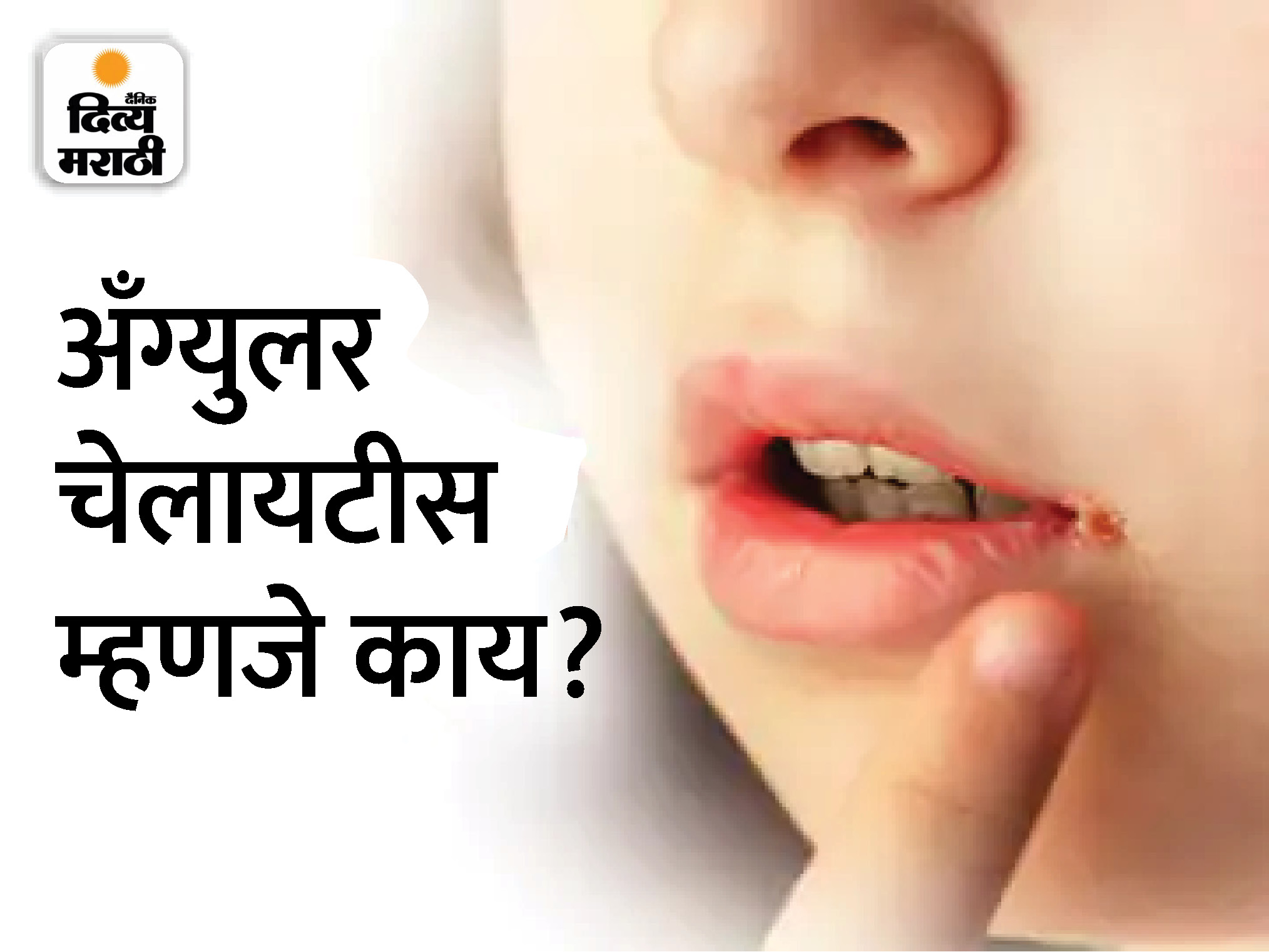 Cracked lips are a sign of disease: iron deficiency, anemia, diabetes ...