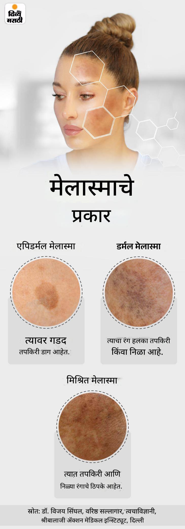 Melasma Initial Symptoms; Skin Brown Or Gray brown Patches | चेहऱ्यावर डाग किंवा ठिपके आहेत: हे ...