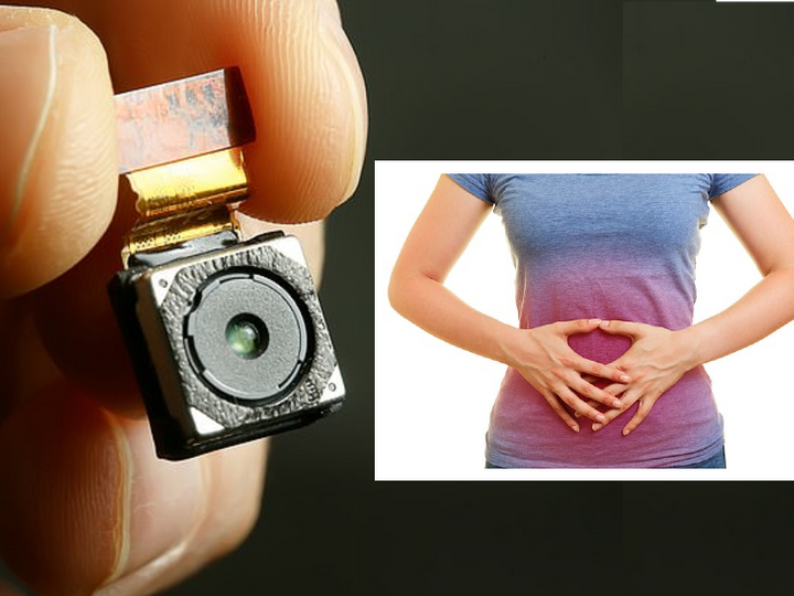 Colon Cancer Treatment; High tech Camera In The Loo Detect Of Bowel Cancer