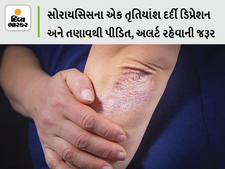 World Psoriasis Day; Everything You Wanted To Know About Skin Disease ...