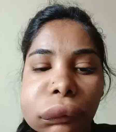 Kannada actress Swati Satish's face disfigured due to wrong surgery ...