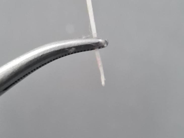 A fish hook stuck in the neck of a one-and-a-half-year-old girl in ...