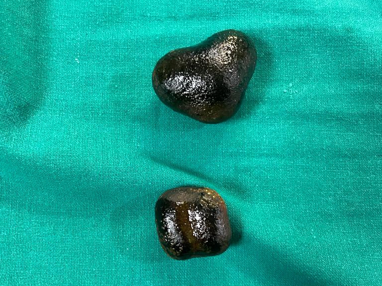 Successful operation of intestinal stone, which is rare in the world ...